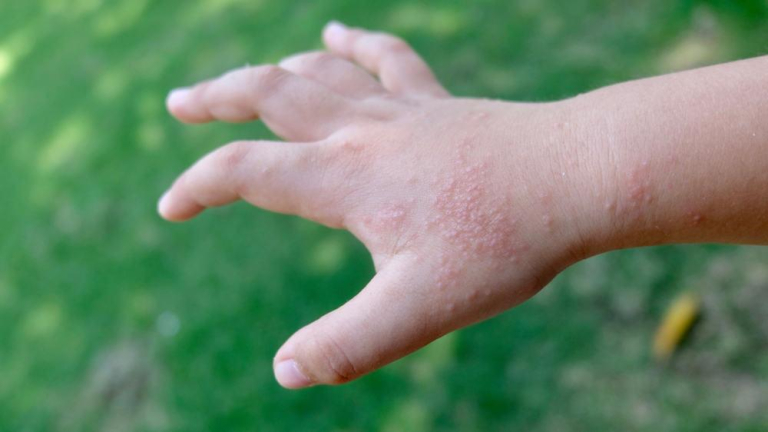 Bệnh chàm tổ đỉa là gì? Triệu chứng & Cách điều trị • Hello Bacsi