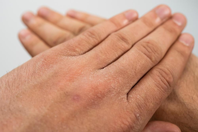 Da tay khô bong tróc: 8 nguyên nhân mà bạn không thể ngờ!