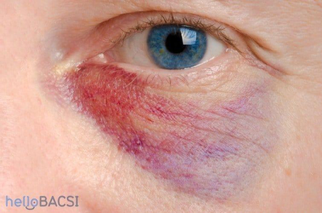 Có phải tự nhiên bị bầm tím mắt và cách làm tan vết bầm nhanh nhất