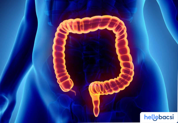 Sự thật về ung thư ruột thừa bạn cần biết • Hello Bacsi