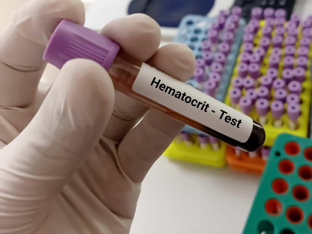 Hct là gì? Quy trình xét nghiệm chỉ số hct trong máu và ý nghĩa kết quả