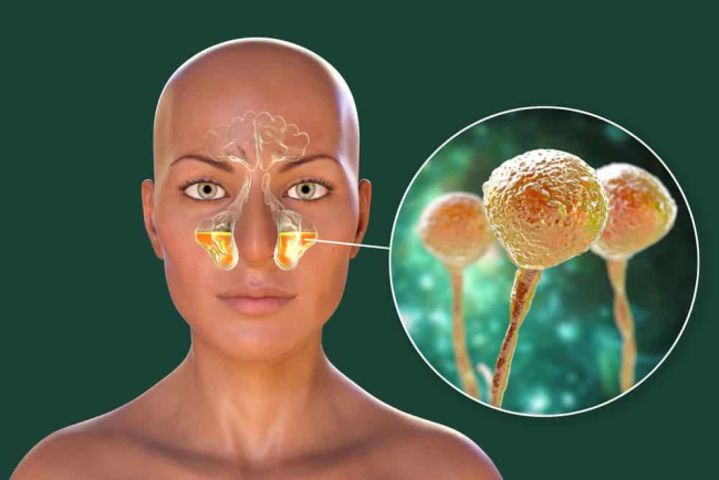 Tổng quan về các loại viêm xoang thường gặp và cách phân biệt