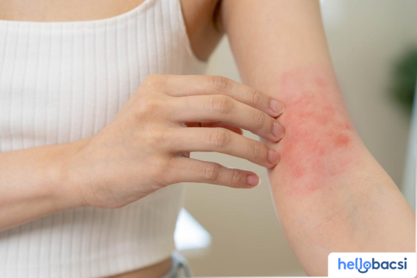 Cách trị rôm sảy ở người lớn tại nhà đơn giản, hiệu quả